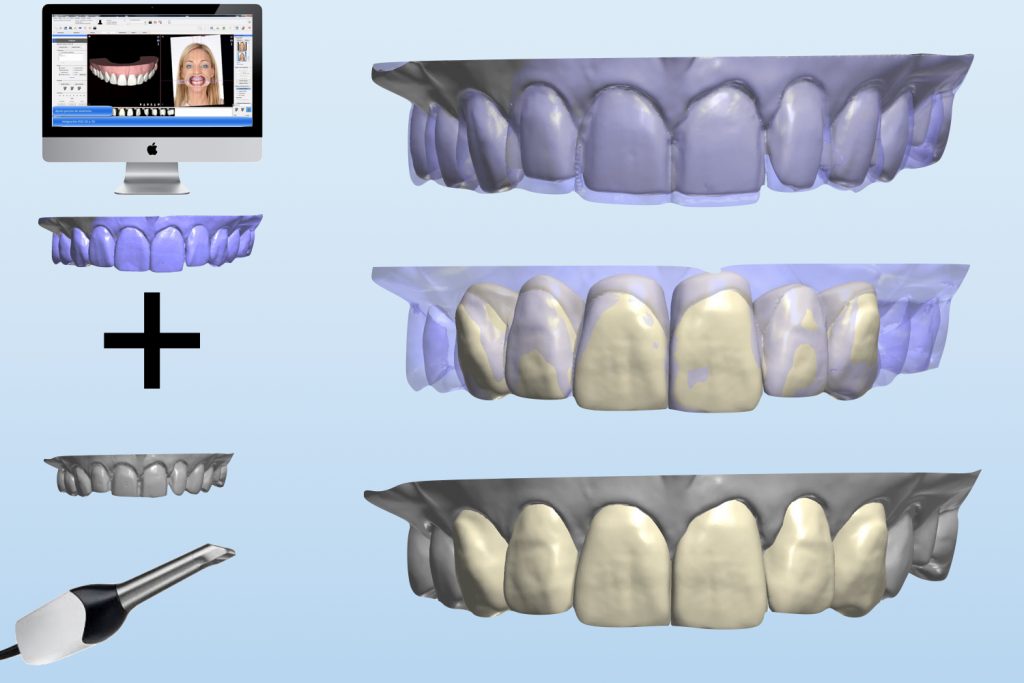 The Monolithic Anterior Natural Digital Restoration – SaudiDent