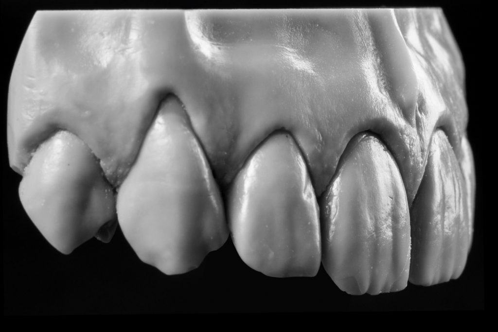 The Monolithic Anterior Natural Digital Restoration – SaudiDent