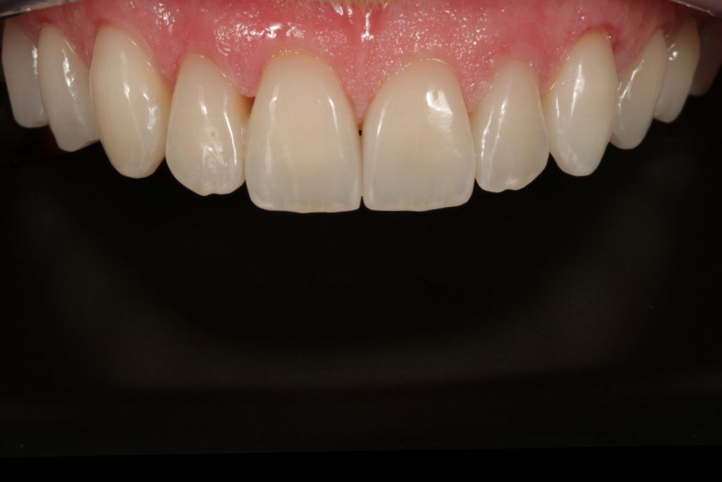 The Monolithic Anterior Natural Digital Restoration – SaudiDent